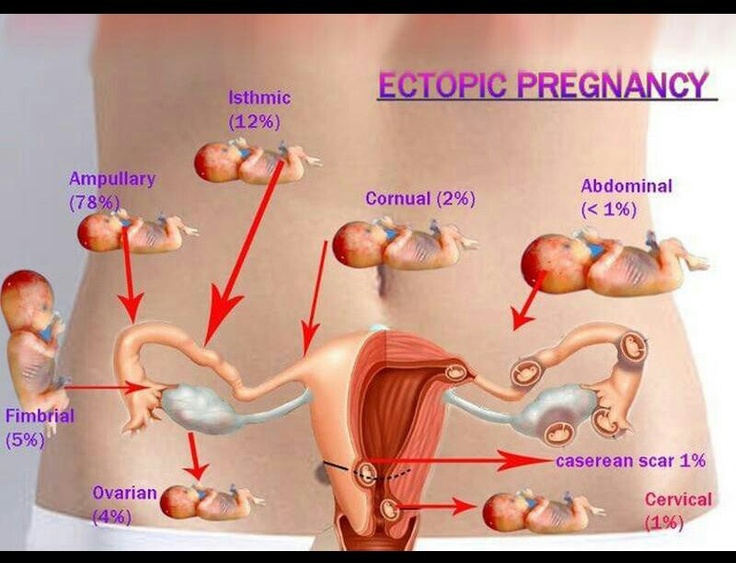 Ectopic Pregnancy Quotes QuotesGram ectopic-pregnancy-quotes-quotesgram