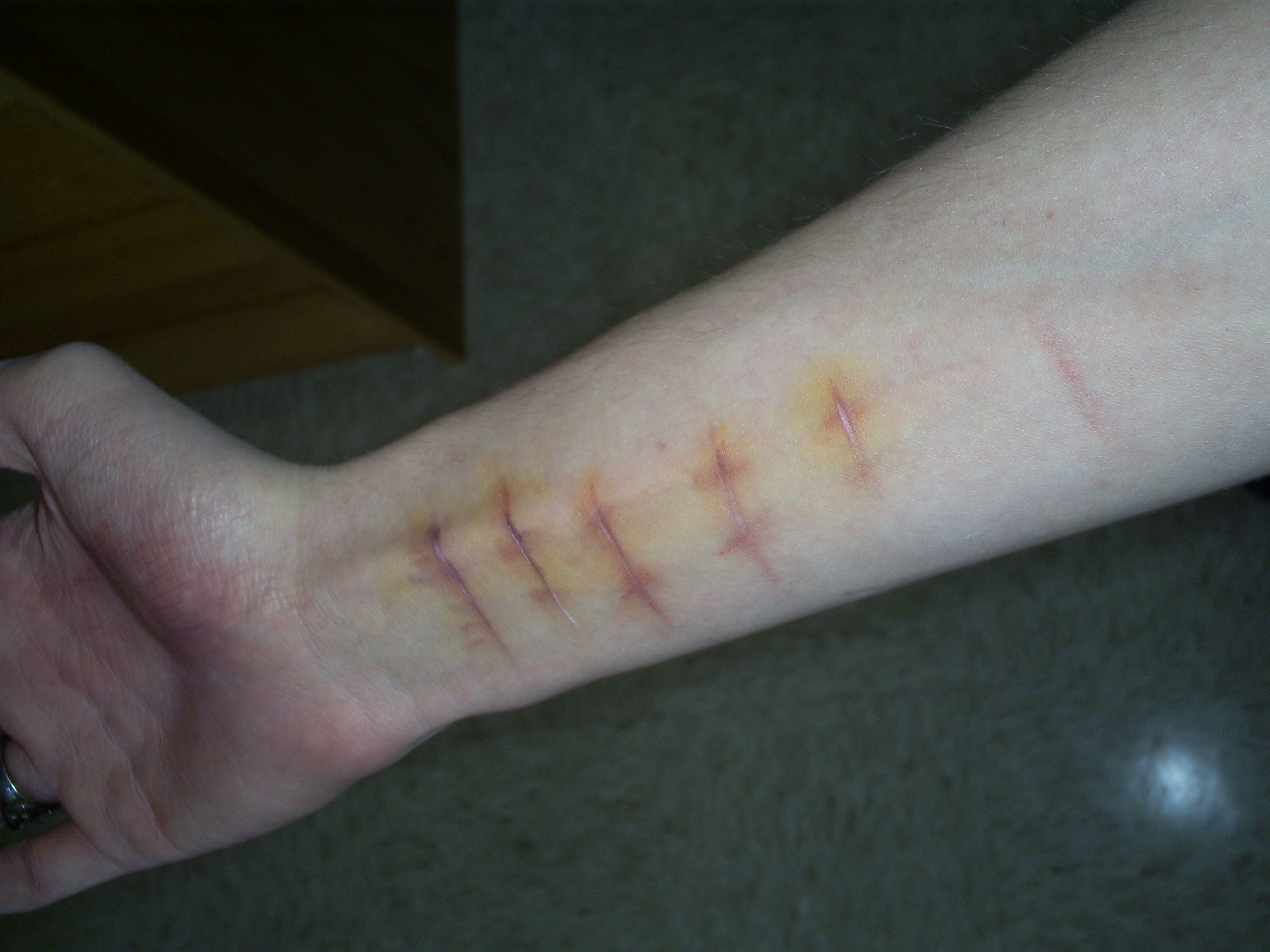 Cuts On Girls Arms